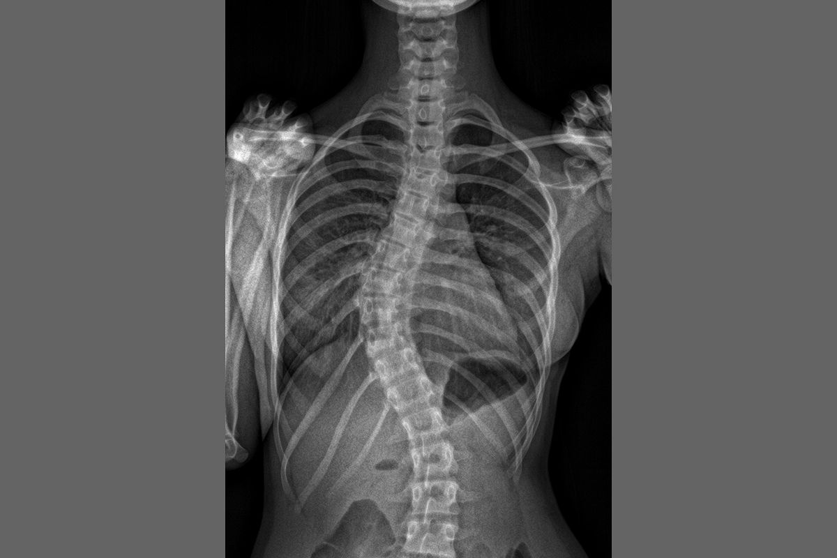 Universitätsklinik Balgrist: Wirbelsäulenkontrolle zur Skolioseprävention