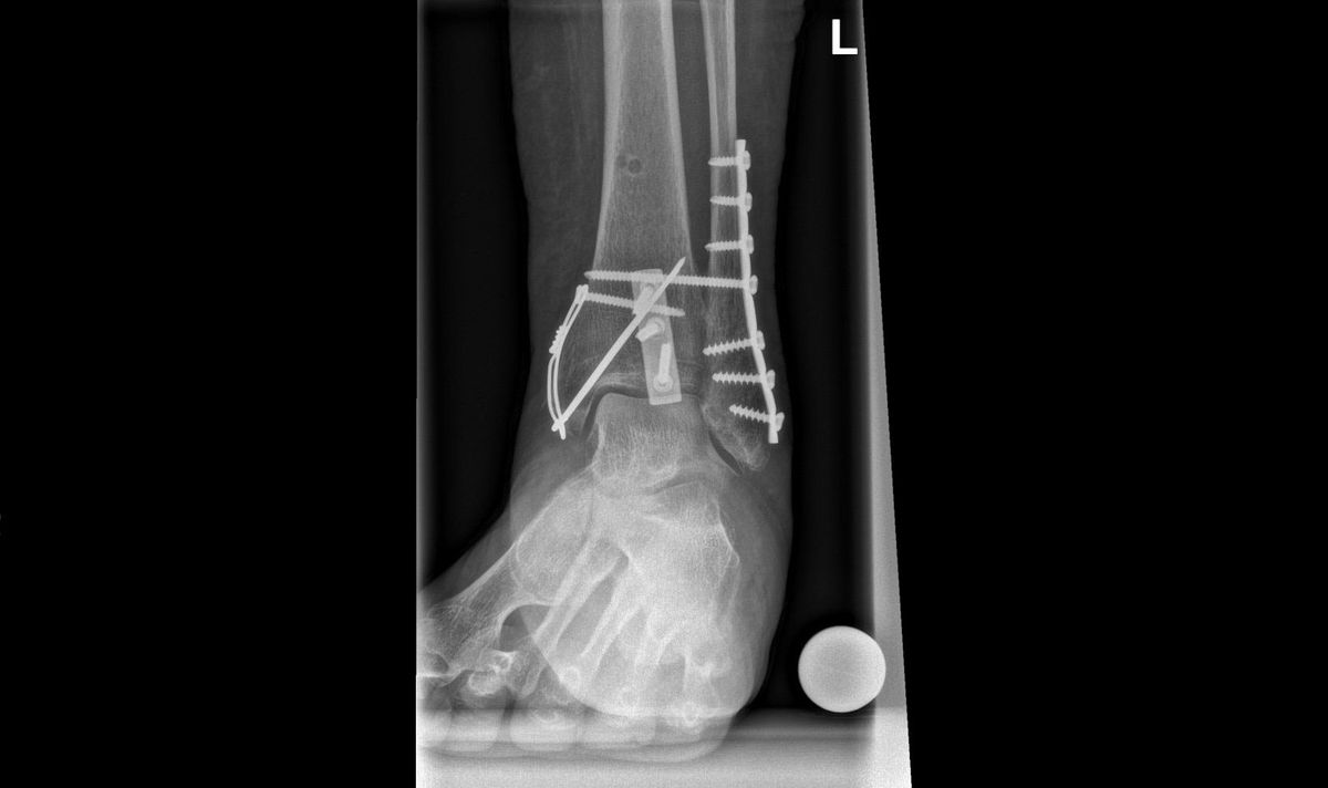 Universitätsklinik Balgrist: Frakturen